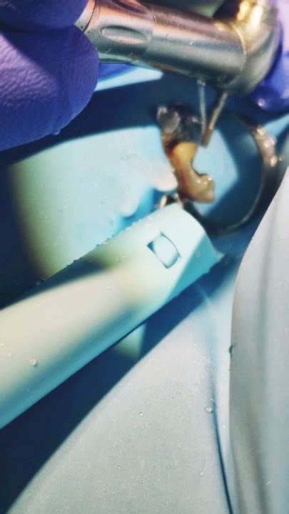 Mydentist Redditch On Linkedin Bioclear Composite Private Fillings