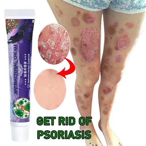 Crema Antibacteriana Para Psoriasis Tratamiento Para Dermatitis Eczematoid Pomada Para