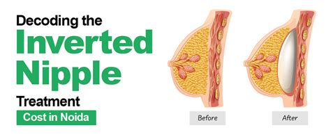 Decoding The Inverted Nipple Treatment Cost In Noida