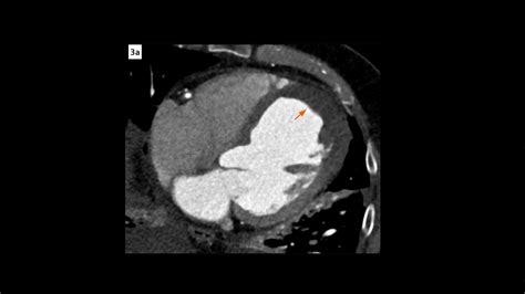 Lad Occlusion Acute Or Chronic
