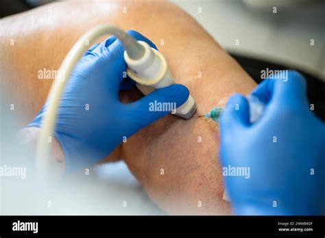 Treatment Of Varicose Veins By Foam Echosclerotherapy Injection Into A