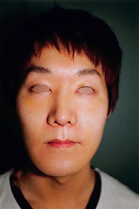 Asian Rhinoplasty Vancouver Cosmetic Surgery