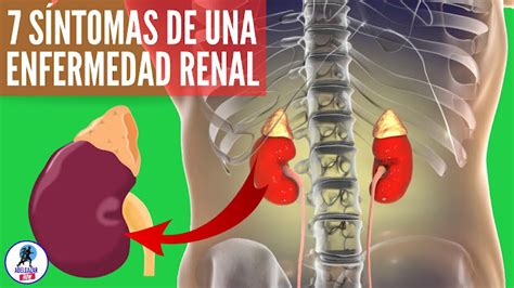 7 Síntomas que te ALERTAN de una Posible Enfermedad en los Riñones