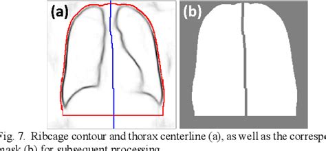 Figure 1 From Lung Field Segmentation In Chest Radiographs From Boundary Maps By A Structured