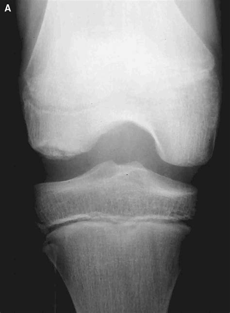 Ask Dr Hacker Management Of Ocd Lesions