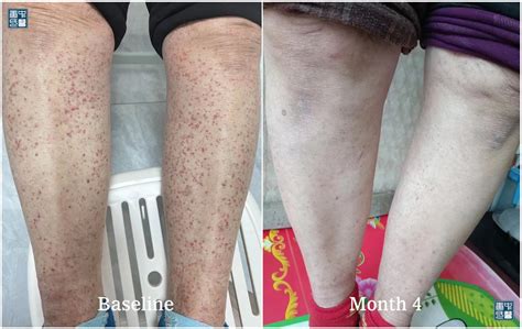 Iga Vasculitis Henoch Schönlein Purpura In The Elderly 老年过敏性紫癜一例