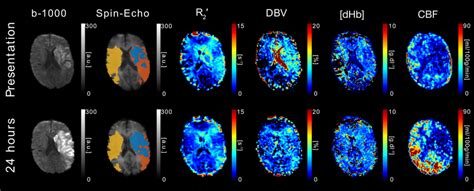 Dwi B 1000 Smm 2 Sqbold Parameter Maps R 2 0 Dbv And Dhb Download Scientific