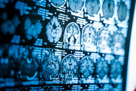Demystifying Medical Imaging Ct Scans Vs Mri