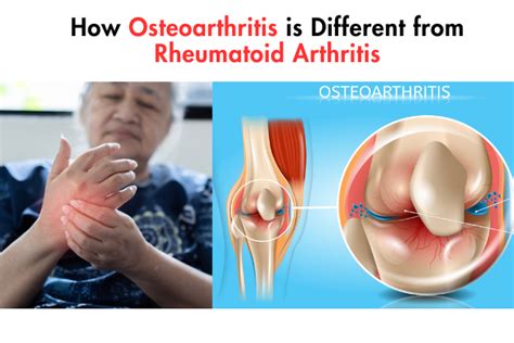 How Osteoarthritis Is Different From Rheumatoid Arthritis All