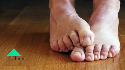 Cara Mudah Merawat Cagu Pada Kuku Kaki Majalah Ilmu