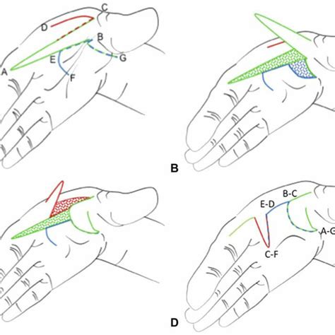 A Preoperative View Demonstrates The Palmar Contracture B Download Scientific Diagram