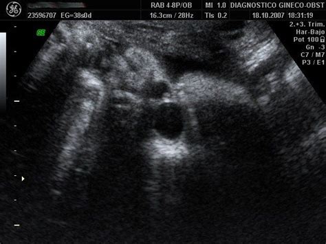 Dacriocistocele Congenital Cyst Of The Nasolacrimal Duct