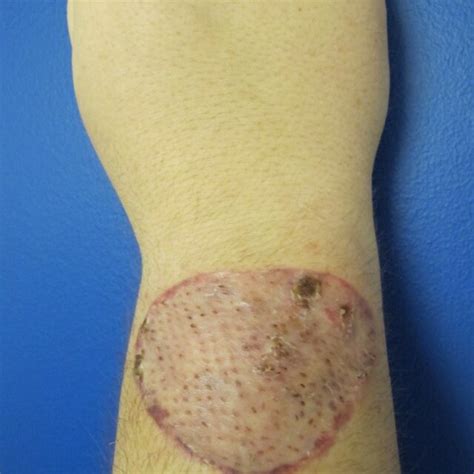Hundred Per Cent Split‐thickness Skin Graft Take 2 Wk Postexcisional