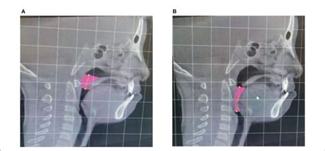 FIGURE Airway Volume Of Palatopharyngeal Segment A And Airway Volume