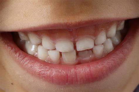 Nonioのマウスウォッシュの効果や味を口コミでチェック！効果的な使い方を解説 役に立ついいね！情報サイト