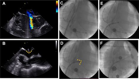 Frontiers 3d Electroanatomical Mapping Of The Left Atrium And Catheter Based Pulmonary Vein