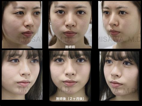 ヴァンパイアフェイシャル Prp ダーマペンの効果・若返り治療 横浜市鶴見の形成・美容外科 エムズクリニック