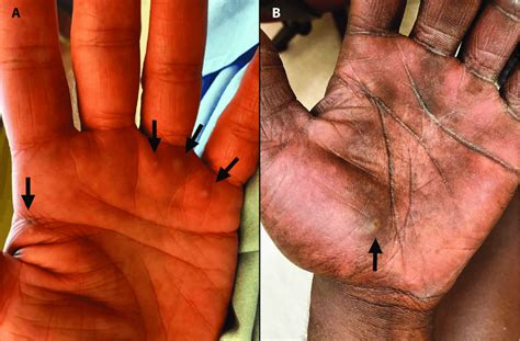 Secondary Palmar Pustules A Four 1 3 Mm Pustules Arrows On The Download Scientific Diagram