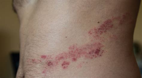Herpes Zoster Prevenção Sintomas e Tratamentos