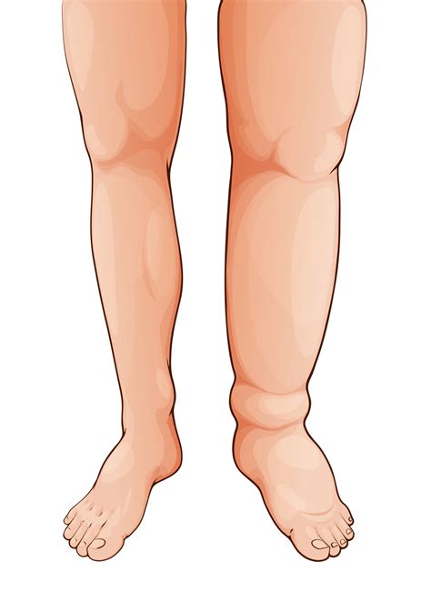 Edema Lymphedema Disease Swollen Leg And Foot 15600234 Vector Art At
