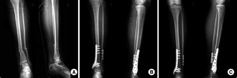 A Years Old Female Sustained A Fracture Of Left Distal Tibia After Download Scientific