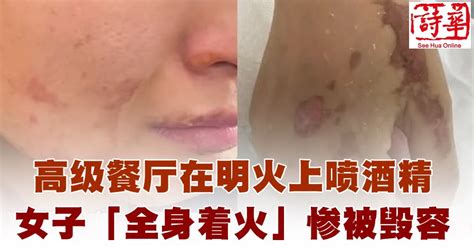高级餐厅在明火上喷酒精 女子「全身着火」惨被毁容 马来西亚诗华日报新闻网