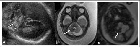 Figure 1 From The Fetal Cerebellum Semantic Scholar