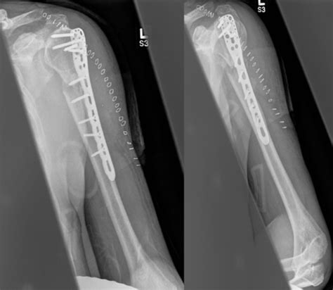 Closed And Open Fractures Flashcards Quizlet