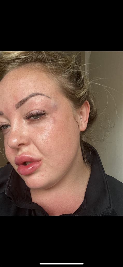 Migrated Lip Filler Rcosmeticsurgery