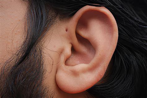 Preauricular Sinus Surgery Singapore Dr Gan Eng Cern