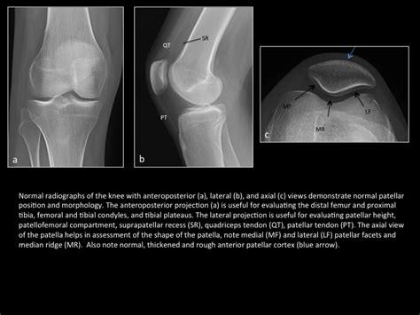 Normal Patella Radiograph Preoperative Skyline View Of The