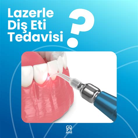 Lazerle Diş Eti Tedavisi Antalya Akar Dental