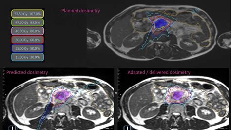 Ablative Stereotactic Radiation Therapy A Promising Approach For