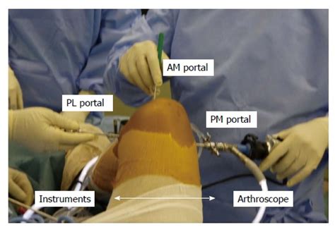 Arthroscopic Approach To The Posterior Compartment Of The Knee Using A