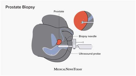 What Is A Transperineal Prostate Biopsy Revealing The Procedure Eroppa