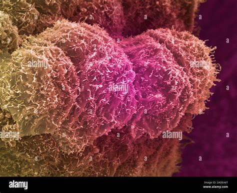 Images Not To Be Used By The Tobacco Industry Prostate Cancer Cells Coloured Scanning Electron
