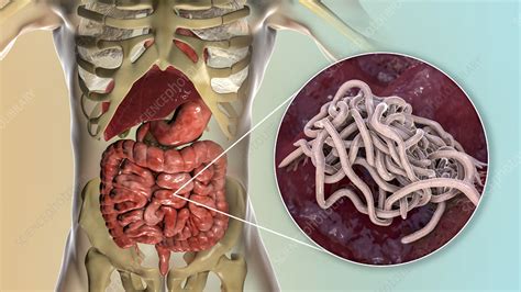 Round Worms In Human Intestine Illustration Stock Image F0326017
