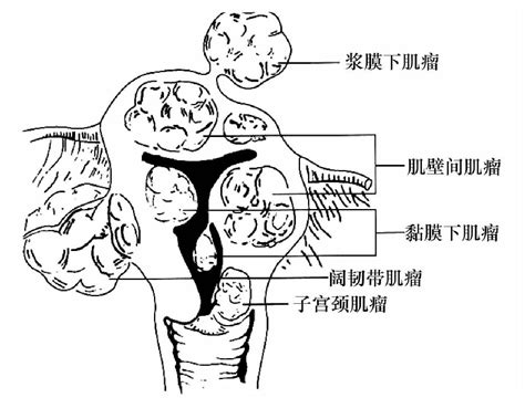 三子宫肌瘤 医学教育 医学