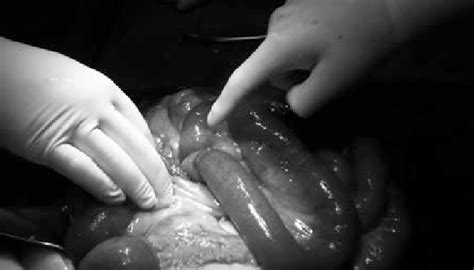 Untwisted Ischemic Closed Bowel Loop Where The Demarcation Border Of