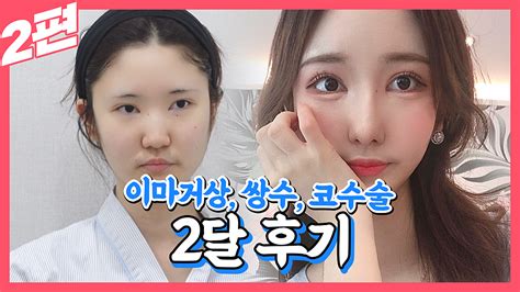 쌍수 코수술 이마거상 성형 2달 변화 눈재수술 쌍꺼풀수술 성형 Vlog 티안나 네이버 Tv