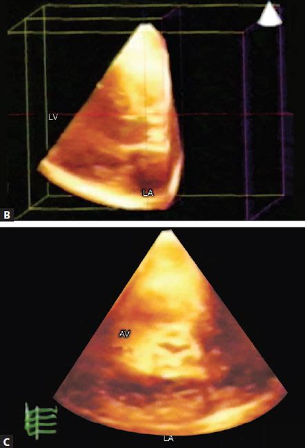Automated Detection Of Severe Aortic Stenosis Using 40 Off