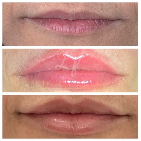 Eu sempre digo para minhas pacientes o inchaço do preenchimento labial