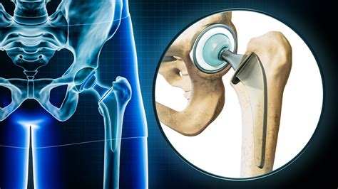 Before You Speak With Broadspire About Your Stryker Rejuvenate Hip