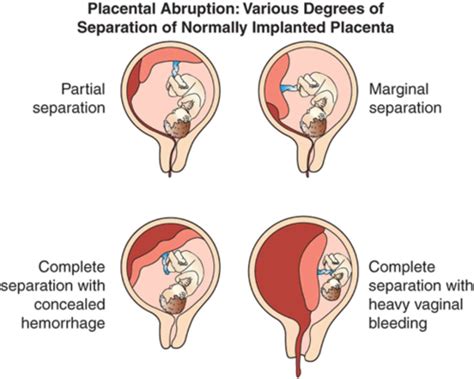 Complications Occurring During Labor And Delivery Part 1 Flashcards
