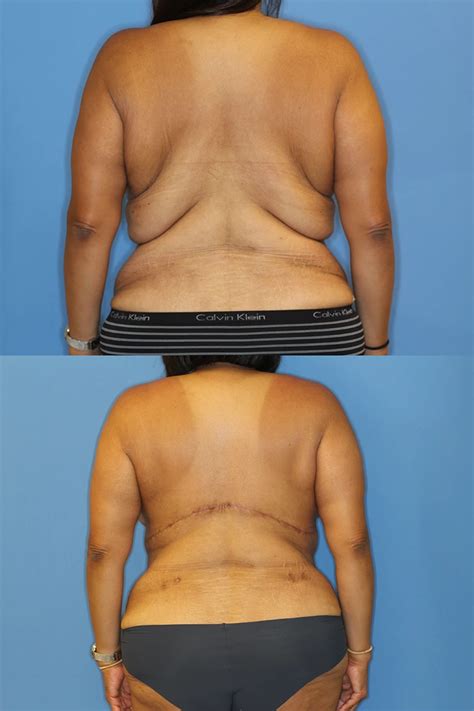 Weight Loss Skin Removal In Omaha Methodist Health System