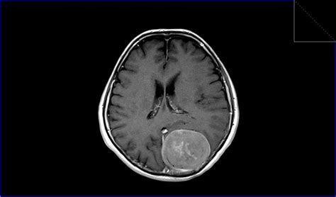 Meningioma Mri