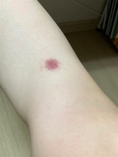 먹파리 물림 벌레 물림 지식in