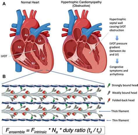 Causes Of Hypertrophic Cardiomyopathy