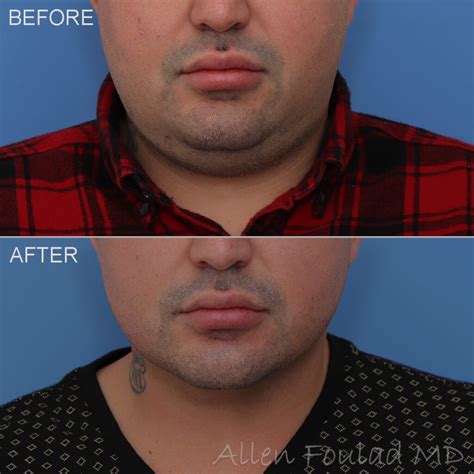 Case 1037 Allen Foulad Md