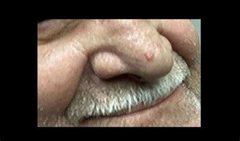 Dermdx Red Bump On Nose Dermatology Advisor